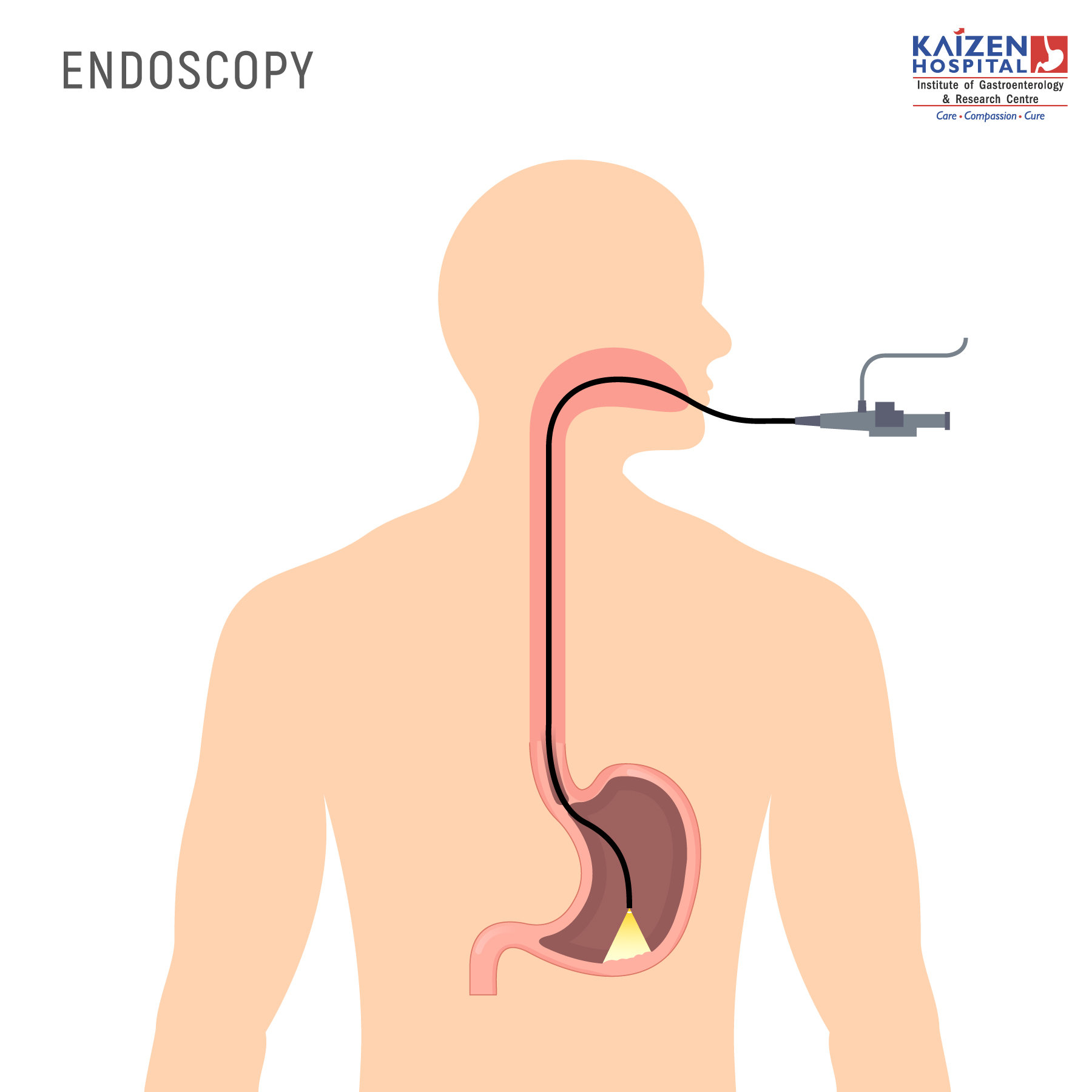 Kaizen Advance Endoscopy Center - Best Gastroenterology Hospital in India