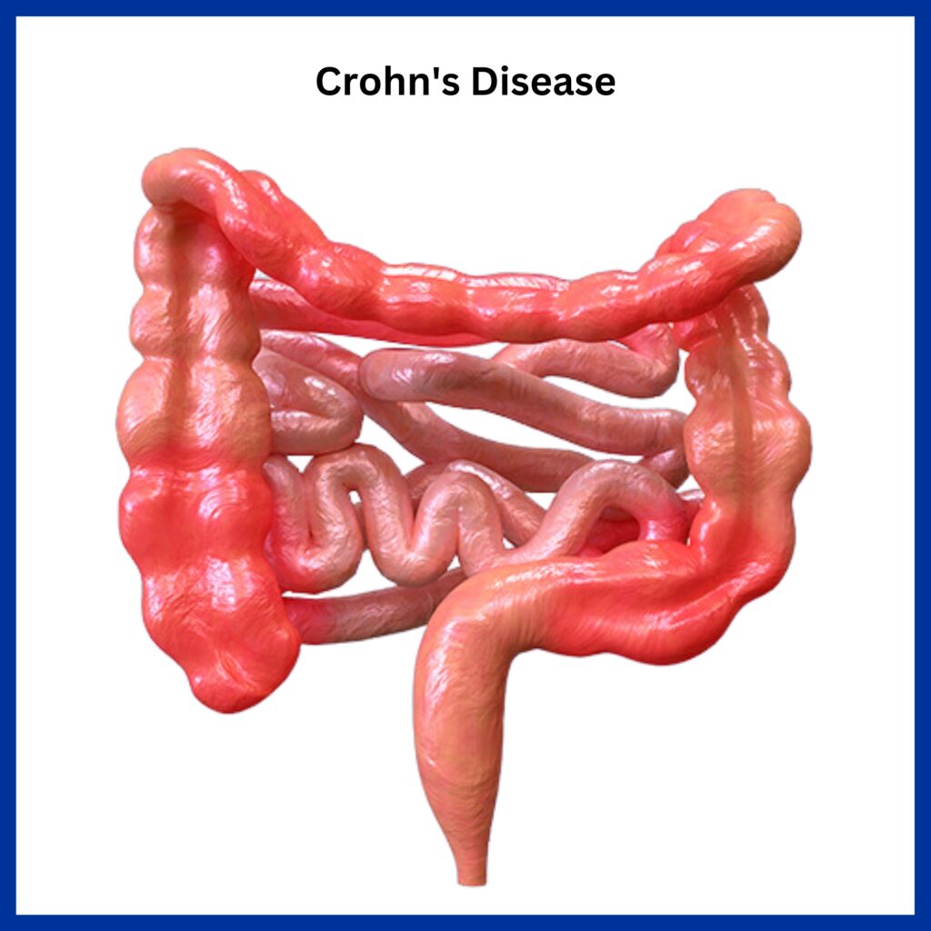 Small Intestine Disease - Kaizen Hospital | Small Bowel Disease