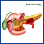 Pancreas Disease - Kaizen Hospital | Pancreatic Cancer Treatment