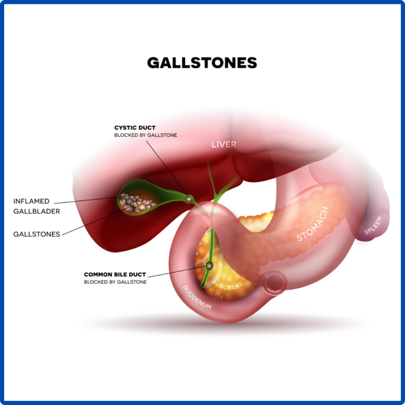 Robotic Gallbladder Surgery in Gujarat, India | Kaizen Hospital