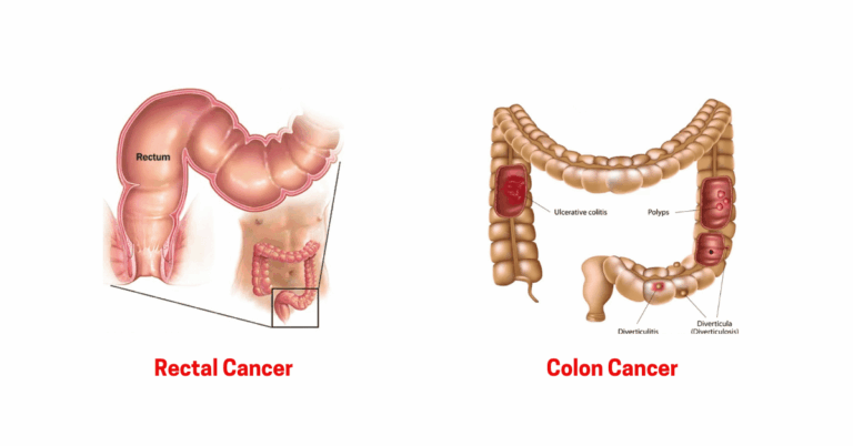 Difference Between Colon Cancer And Rectal Cancer Kaizen Hospital