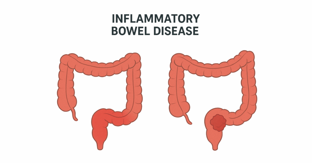 Inflammatory Bowel Disease: Causes, Symptoms, and Treatments